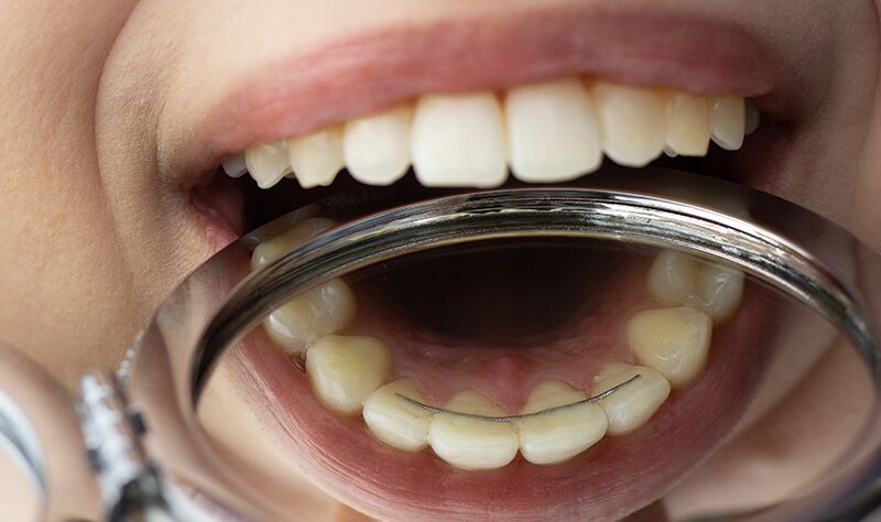 Teeth Retainers in Dubai - Retainers after Braces